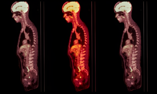 When to Consider a Full Body PET Scan: A Comprehensive Guide