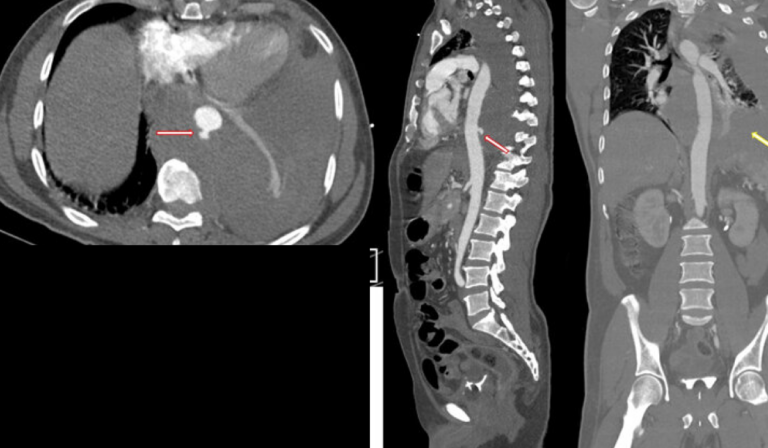 What is a CT aortogram and how does it work?