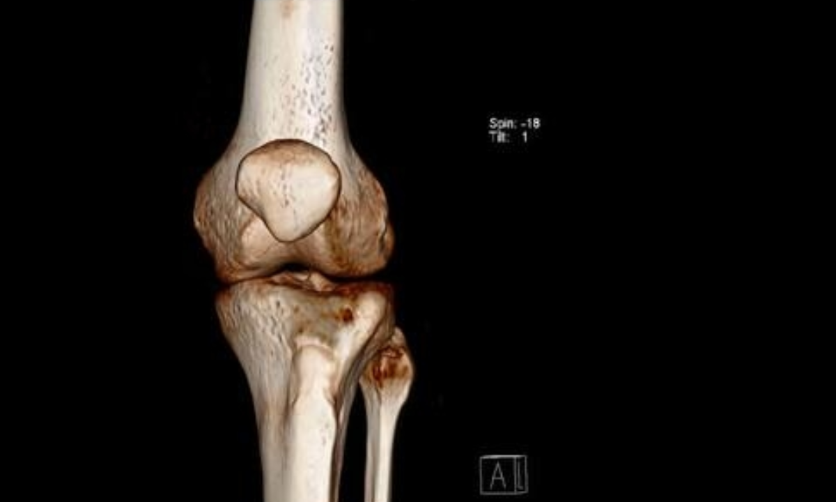 Why Choose Bone PET-CT for Diagnosing Bone Issues?