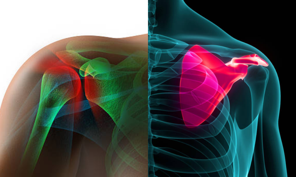 What You Need to Know About Shoulder CT Scans