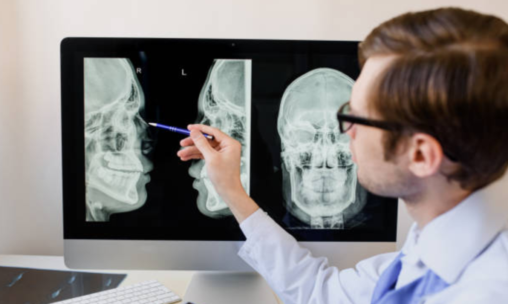 Why are CT scans necessary for nasal bone fractures?