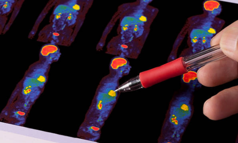 Top 5 Facts to Know Before Your First FDG PET CT Scan