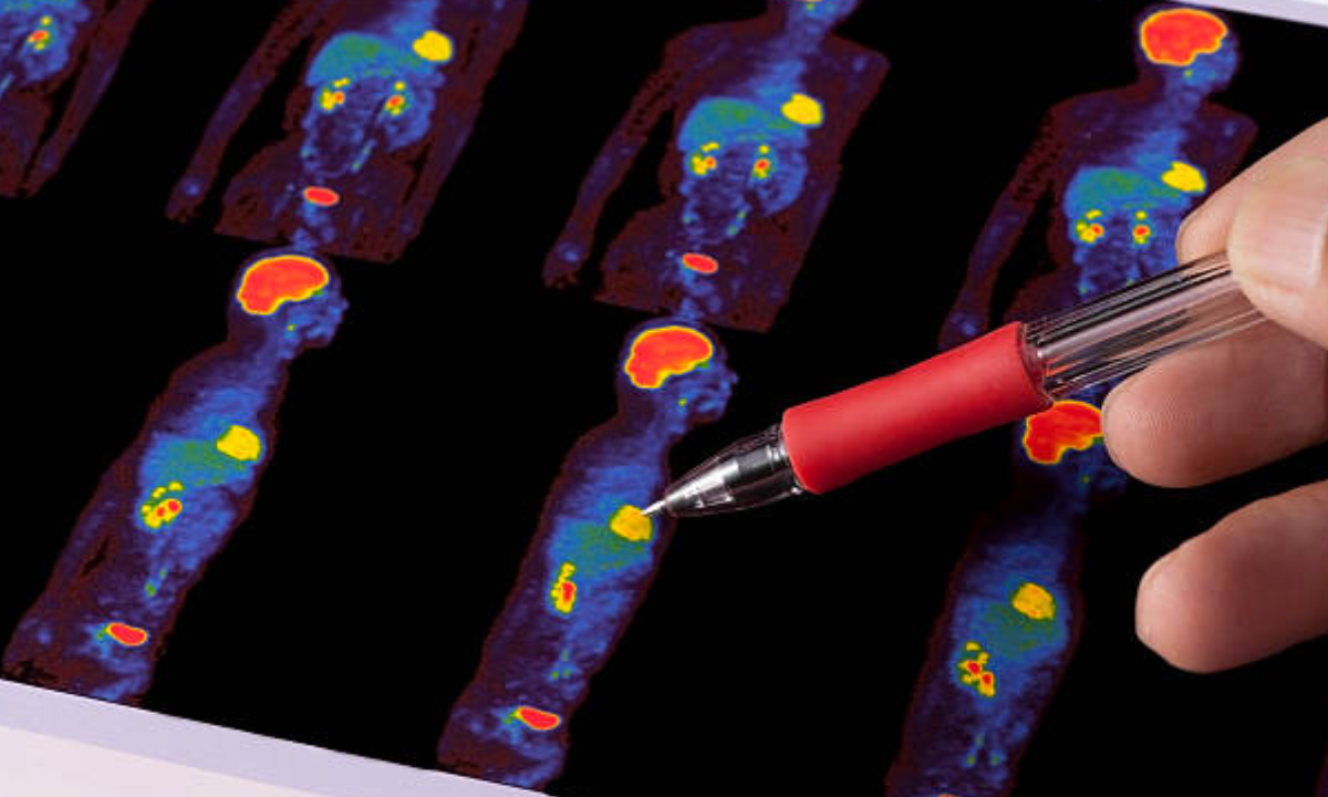 5 Signs You May Need an FDG PET CT Scan