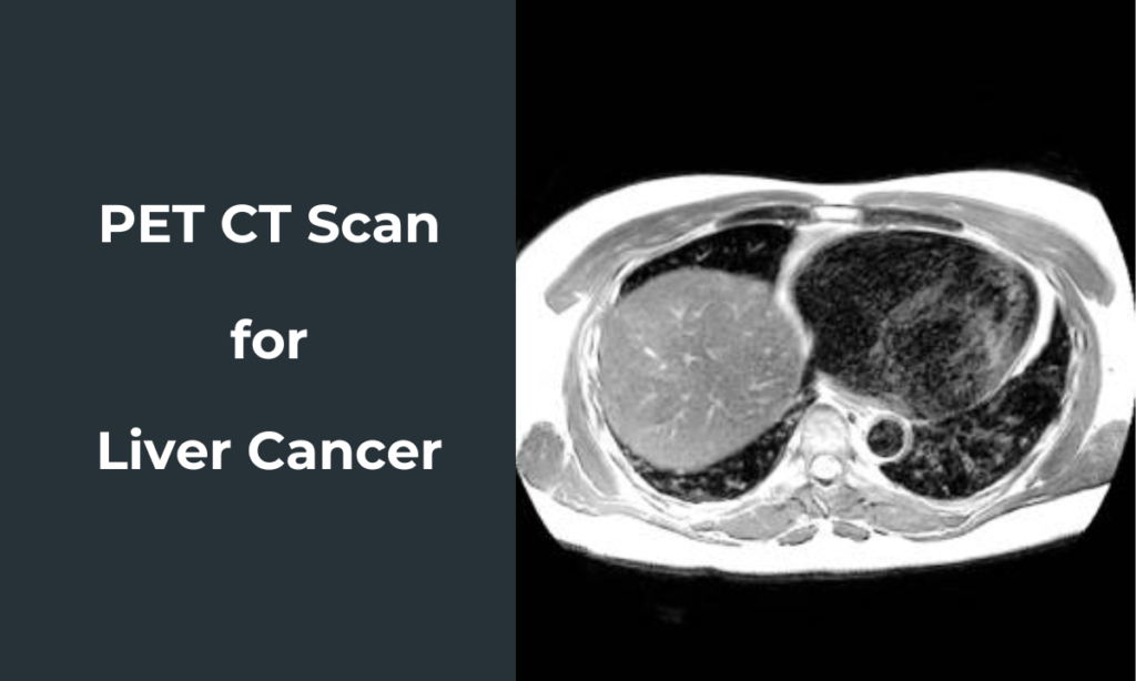 Liver Cancer diagnosis & evaluation with PET CT scans