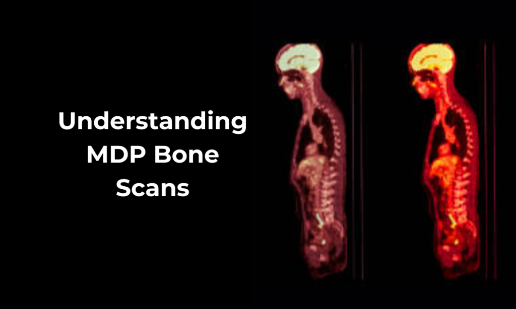 Understanding MDP Bone Scans: A Comprehensive Guide