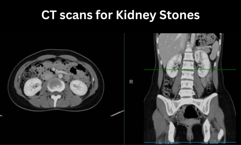 CT Scans for Kidney Stones: Fast, Accurate, and Non-Invasive