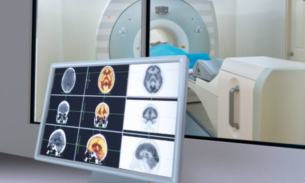 DOPA PET Scan: A Powerful Tool for Neurological Imaging